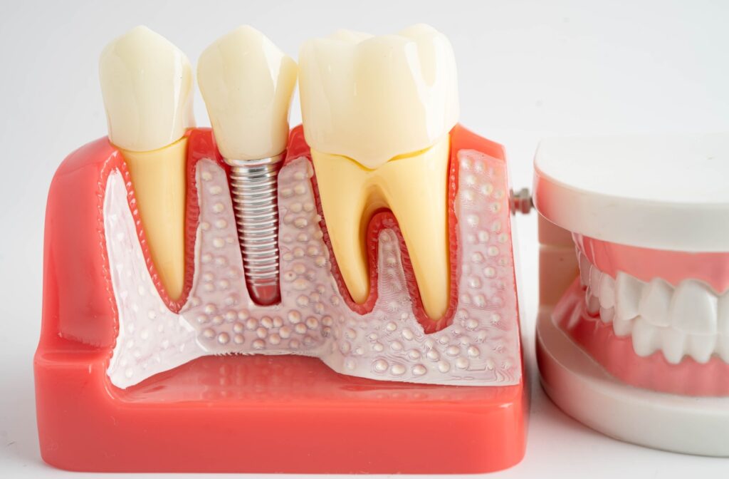 Ceramic vs. Titanium Implants: Which Should You Choose?